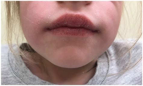 Lip Swelling At Presentation Download Scientific Diagram