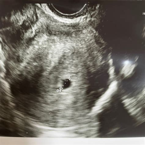 Bt19 胎嚢確認 1人目不妊治療挑戦の記録！★