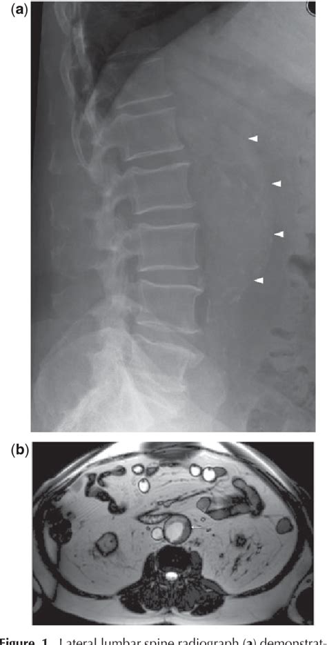 Abdominal Aortic Aneurysm Lateral Xray