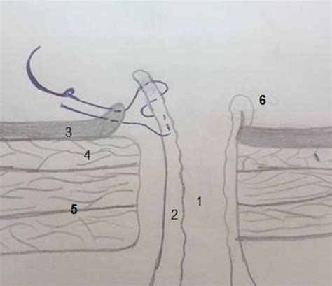 A Modified Interrupted Seromuscular Vertical Mattress Suture Pattern
