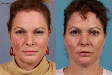 Vbeam Perfecta Laser Before And After Home Design Ideas