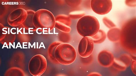 Sickle Cell Anaemia Types Causes Treatment Genetics Diagnosis
