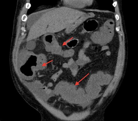 Computed Tomography Showing Pancolitis Download Scientific Diagram