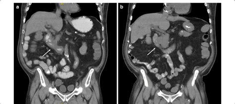 A Ct Abdomenpelvis On Initial Presentation With Enteritis And Lack Of Download Scientific