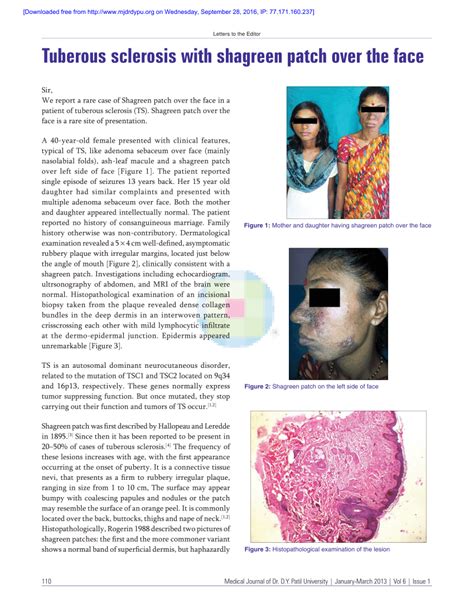 Pdf Tuberous Sclerosis With Shagreen Patch Over The Face