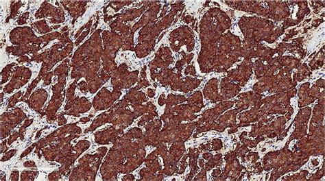 Positive Synaptophysin Staining Of Right Testis In Primary Carcinoid Download Scientific