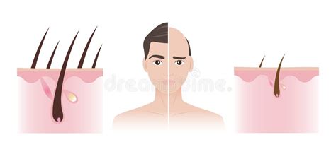 Scalp Layer Stock Illustrations 1 204 Scalp Layer Stock Illustrations Vectors And Clipart