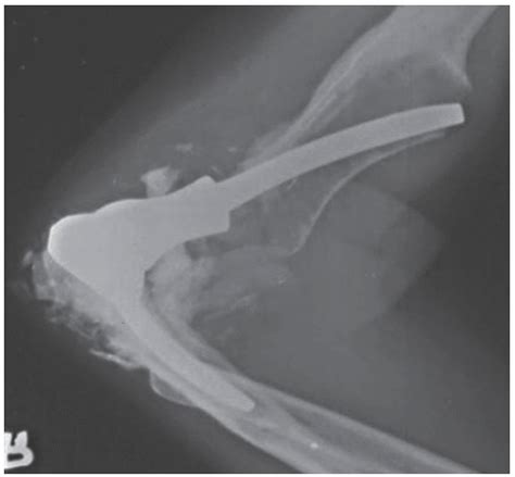Massive Bone Loss About The Elbow Musculoskeletal Key