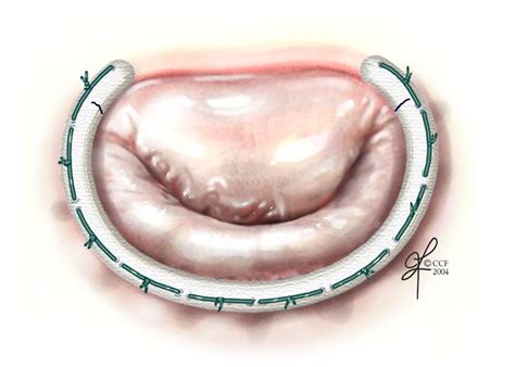 Mitral Valve Repair