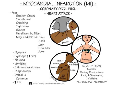 Myocardial Infarction Medical Pinterest