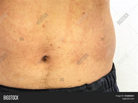 Itchy Body Rash Caused Image And Photo Free Trial Bigstock