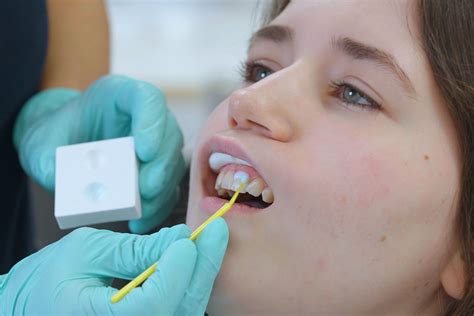 Desensitizing Gel For Teeth Predicta® Bioactive Desensitizer