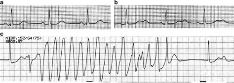 Lansoprazole Precipitated Qt Prolongation And Torsade De Pointes