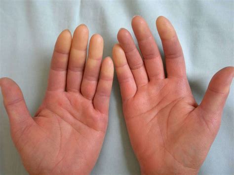 Scleroderma 10 Scleroderma Symptoms