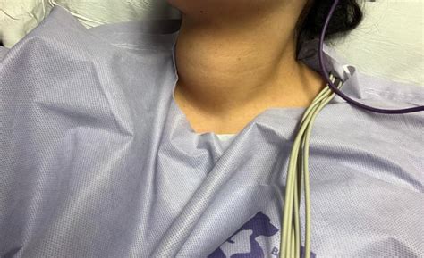 Thyroid Lobectomy Recovery And Heavy Schoolwork R Thyroidcancer