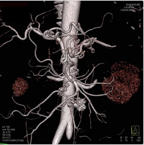 Sclerosing Mesenteritis With Calcified Mesenteric Mass Small Bowel