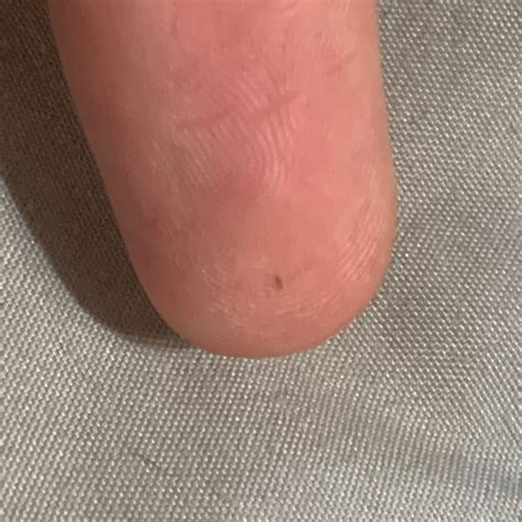 Identifying A Tiny Bug The Keeps Crawling On My Skin Thriftyfun