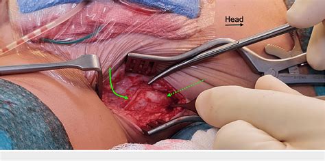 Figure 1 From The Y Pelvic Osteotomy In Treating Bladder Exstrophy A Surgical Technique