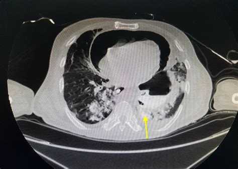 Ct Scan Revealed Oral Contrast Inside The Bronchus Download Scientific Diagram