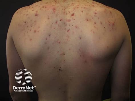 Moderate Body Acne