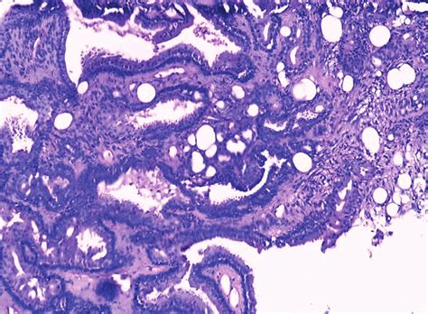 Section Shows Papillary Projection Lined By Two Row Of Cells The