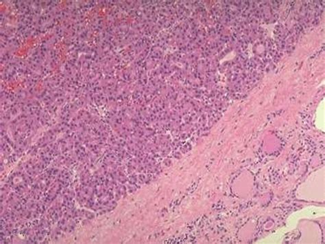 Thyroid Neoplasms Of Pathology Robbins Pptx