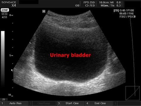 Urinary Bladder Sonography Medicína Nemoci Studium Na 1 Lf Uk