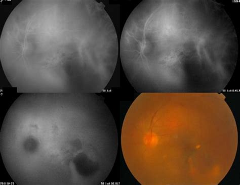 Avens Publishing Group Valsalva Retinopathy Associated With Choking