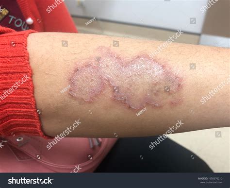 Tinea Corporis Arm