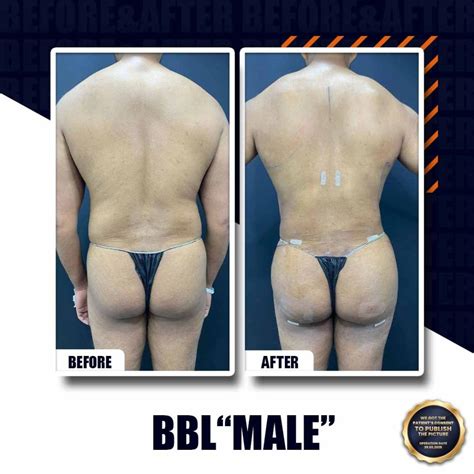 2025 Male Bbl Gluteal Augmentation In Istanbul Turkey Cevre Hospital