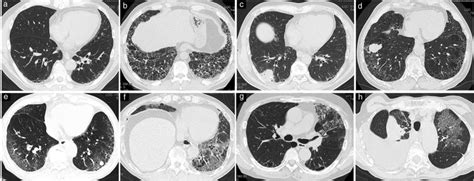 High‐resolution Computed Tomography Hrct Image Of The Chest A Download Scientific Diagram