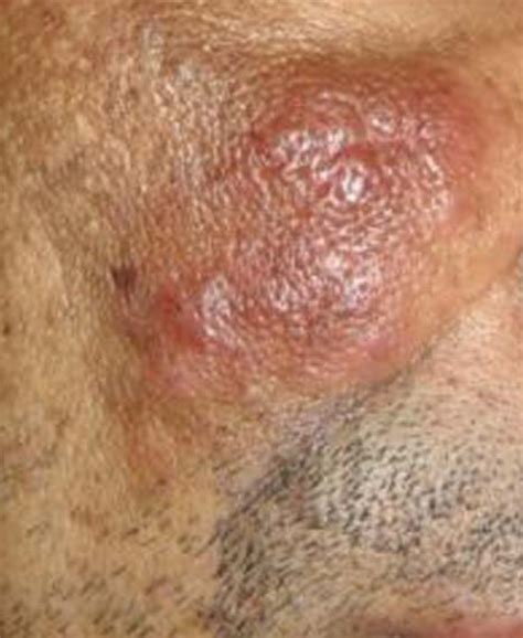 Pretreatment Erythematous Plaque Infiltrated On The Right Malar