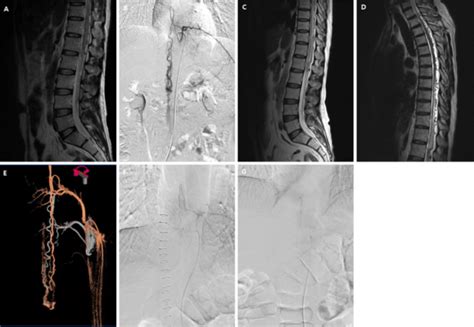 Treatment Of Conus Medullaris Arteriovenous Malformation The Role Of