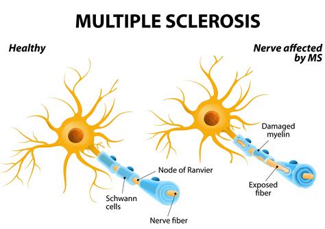 Multiple Sclerosis Ms Anova Irm Germany