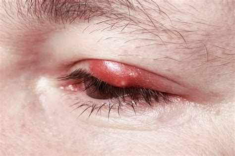 Blepharitis Information And Treatment Lockport Eye Care