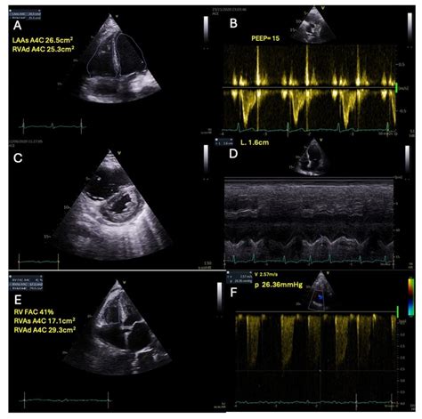 The Heart Evolution Of Myocardial Infarction And Facebook