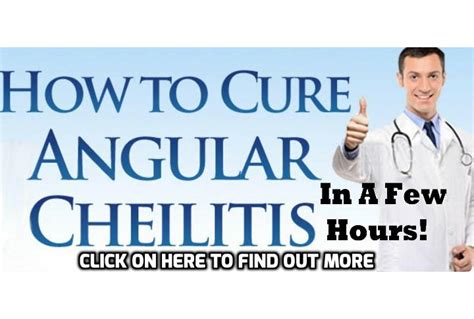 How To Have A Healthy Life Most Common Causes Of Angular Cheilitis And How Can It Be Avoided