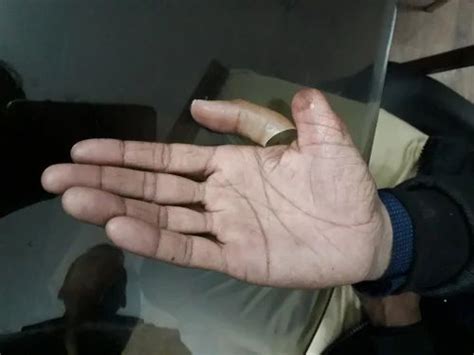 Silicone Thumb Prosthesis Below The Elbow At Rs 12999 In New Delhi