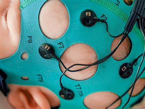 Preventive Epilepsy Treatment With Vigabatrin Does Not Improve Neurocognitive Development In Tsc