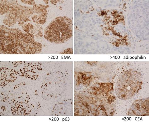 Figure 5 From A Patient With Refractory Psoriasis Who Developed