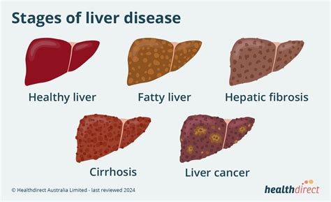 Liver Failure Symptoms Healthdirect