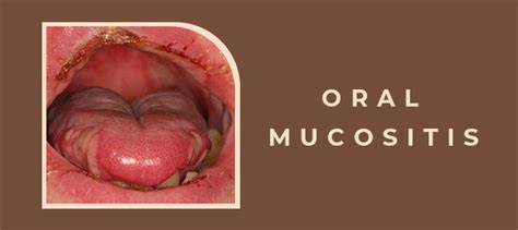 Mucositis Symptoms Oral Findings In Patients With COVID Actas