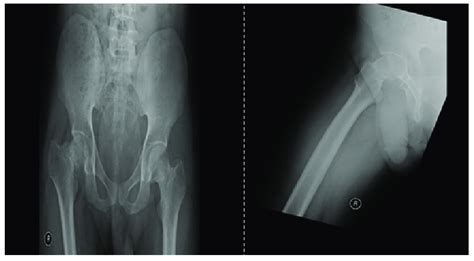 Anteroposterior X Ray At Presentation Showing Displaced Intracapsular