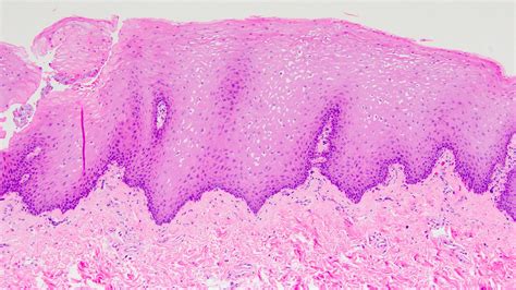 Pathology Outlines Squamous Metaplasia