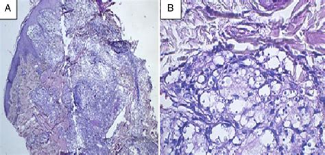 Criptococosis Diseminada Con Afectación Cutánea En Un Paciente Con Sida Piel Formación