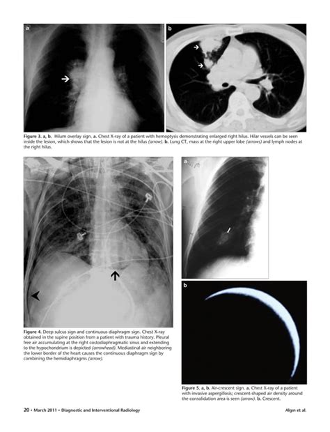 Signs In Chest Imaging Pdf Lung And Respiratory Health Diseases