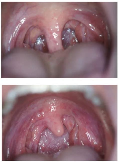 Tonsils Tonsils And Sleep Apnea Eos Sleep