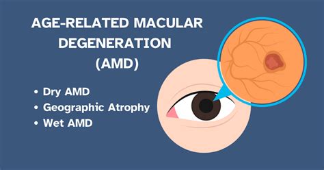 Understanding Age Related Macular Degeneration Dry Geographic Atrophy