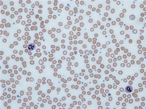 Red Blood Cell Inclusions And Abnormalities Hematology