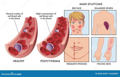 Medical Illustration With Polycythemia Cartoon Vector 282616399